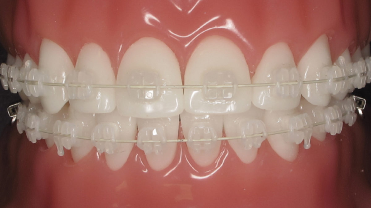 Perfect Ceramic Braces & Clips Treatment - Finedent Dental Clinic